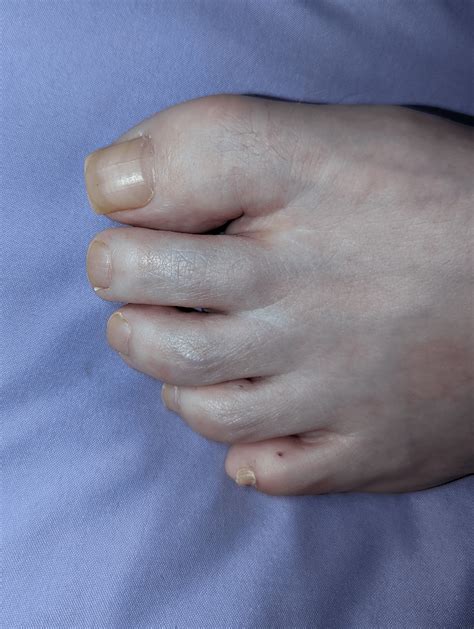 Left Big Toe But Also Toe Next To It Rfootfunction