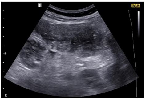 Gastrointestinal Ultrasound In Emergency Setting