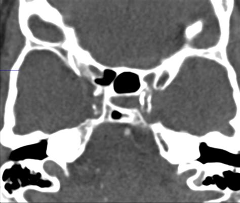 Double Stenting Technique Thrombectomy And Pta Treatment For