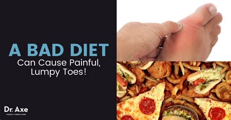 Gout Symptoms Natural Treatments To Relieve Pain Dr Axe