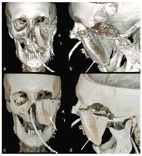 Vr A B And Pt C D Reconstruction Of The Scapular Bone Flap Download Scientific Diagram
