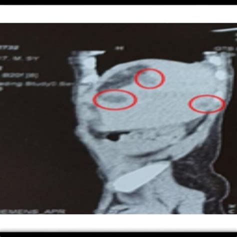 Sagittal Section Showing Multiple Hypodense Non Enhancing Lesions In