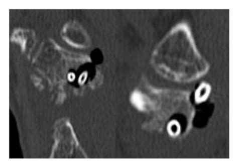Ct Scan Taken 6 Weeks After Triscaphoid Arthrodesis Download