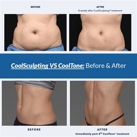 Coolsculpting Vs Cooltone Which Is Best For You The Derm
