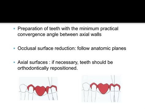 Principles Of Tooth Preparation In Fixed Partial Dentures Pptx