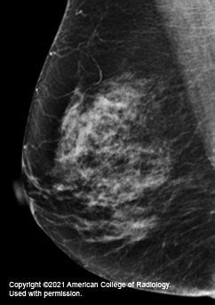 Dense Breast Tissue Breast Density And Mammogram Reports 黑料大湿posts Cancer Society