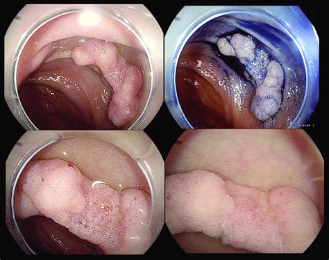 Cecal Polyp Of 3 Cm Size With A Demarcated Central Showing Suspicious
