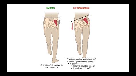 Trendelenburg Sign Explained Youtube