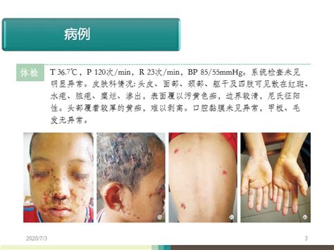 天疱疮病例讨论ppt