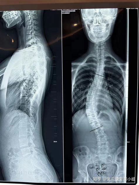康复案例49——15岁女孩46度脊柱侧弯矫正 知乎