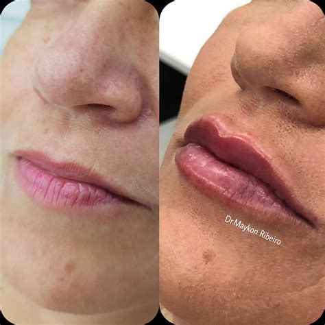 Técnica Perfect Lipspreenchimento Clínica Mater Dei
