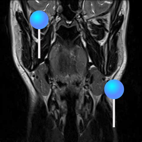 Lingual Tonsils Mri