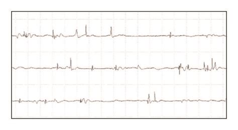 Needle Electromyography Of The Biceps Brachii Muscle Polyphasic Short