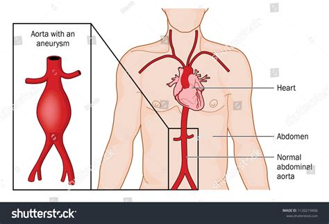 Diagrama De La Aorta Abdominal Síntesis De Las Enfermedades Que