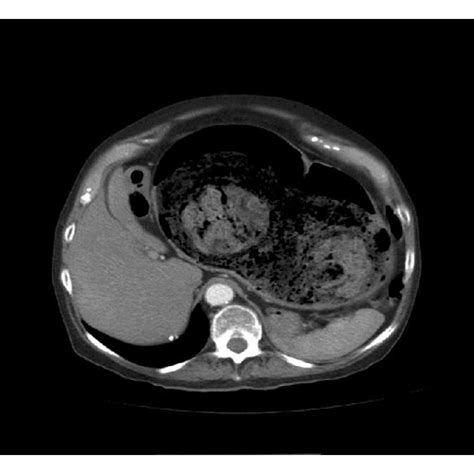 A Ct Scan Showing Grossly Distended Sigmoid Containing Faeces B