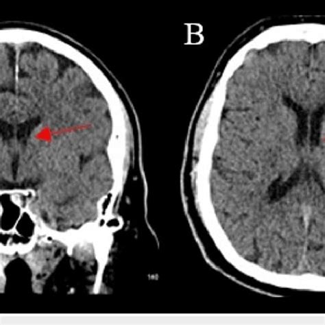 Brain Ct At Two Month Follow Up A Two Month Non Contrast Head Ct