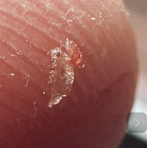 Is This A Bug Parasite Or Just Skin Rparasitecontrol