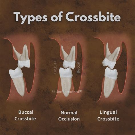 Bites Cross Bites Dentistry Learningtips Bitesnbraces Smile