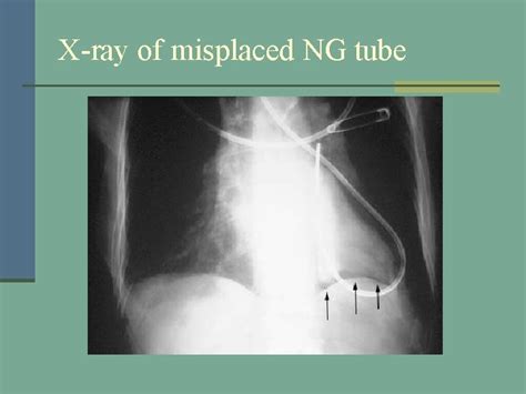 Gastrointestinal Intubation Nasogastric Tubes Enteral Feedings Overview N
