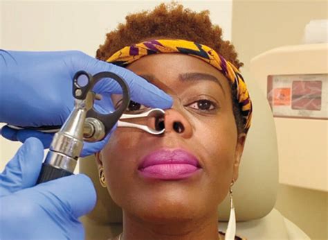 Pros And Cons Of Nose Cauterization Everything You Need To Know