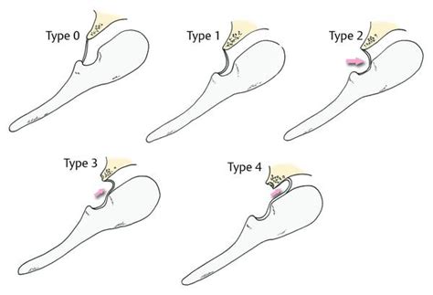 Exclusively Endoscopic Treatment Of Severe Attic Retraction And