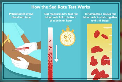 Esr Test Testing Levels And More Engiomed