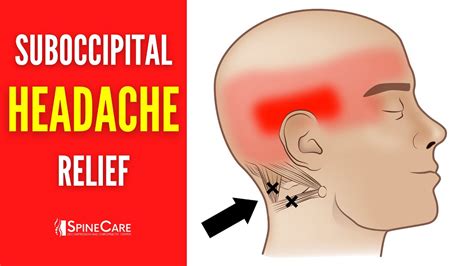 Suboccipital Trigger Points