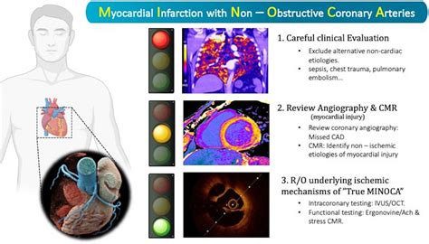 Role Of Cardiac Imaging In Myocardial Infarction With Non‐obstructive
