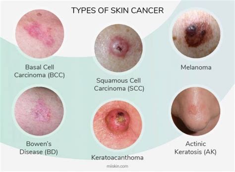 Skin Cancer Types Symptoms Causes And Prevention