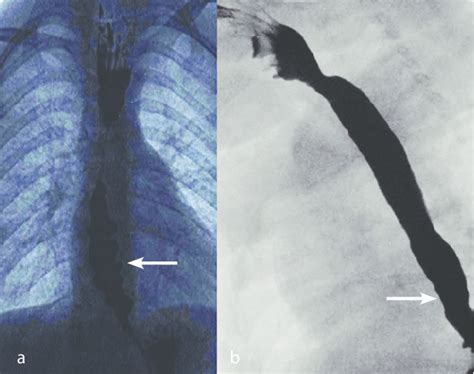 Esophageal Motility Disorders A Marked Nonpropulsive Tertiary