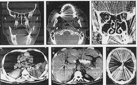 Ct Heavy Streaks Or Star Artifacts Metallic Fillings In Teeth A Download Scientific Diagram