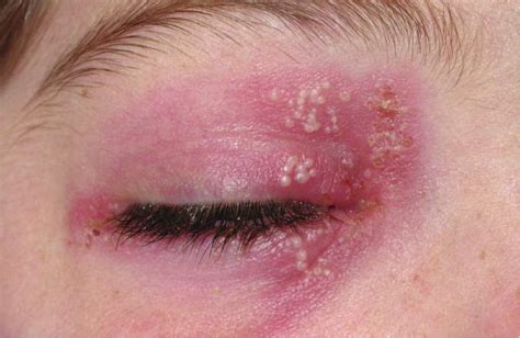 Itchy Eyes Herpes At Gladys Roy Blog