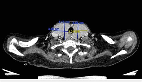 Neck Ct Coronal View The Yellow And Blue Lines Delineate The Size Of