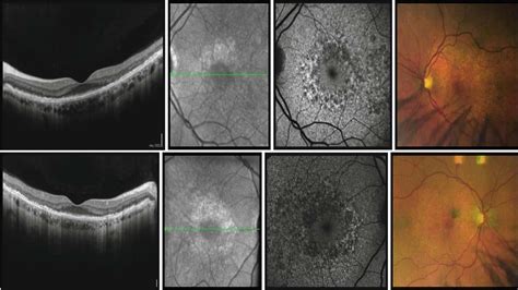 New Potential Treatments For Late Onset Retinal Degeneration L Ord