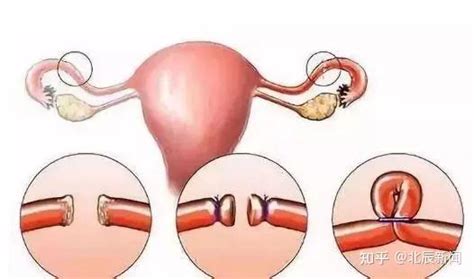 上海哪家医院做了结扎了还能复通吗？ 别让输卵管结扎，阻碍了孕育梦想~ 知乎