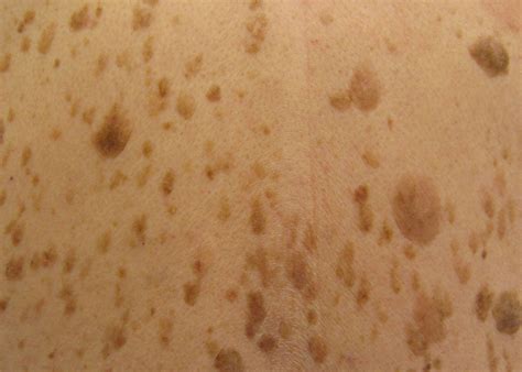 Preventing And Treating Benign Barnacles Seborrheic Keratoses On The