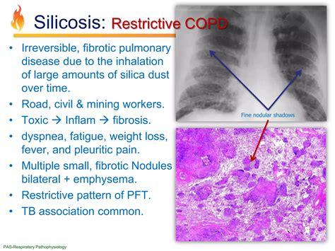 Pathology Of Respiratory System Disorders Pptx