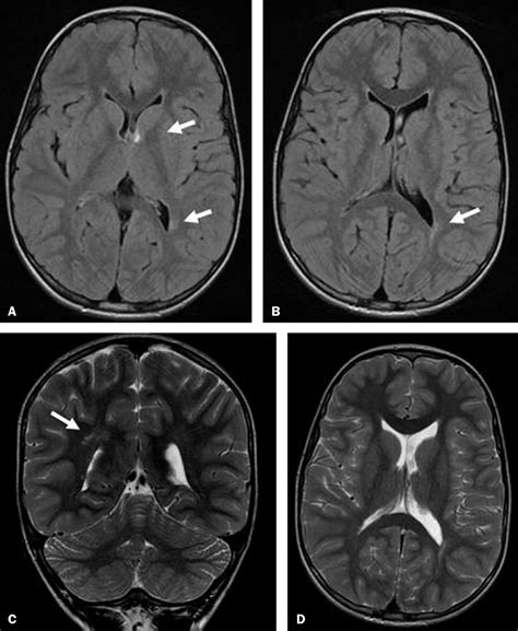 Radiopaedia Lateral Ventricles At Richard Thurmond Blog