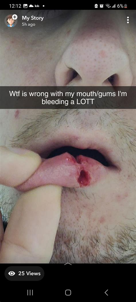 Theres Bugs In My Skin Rmeth