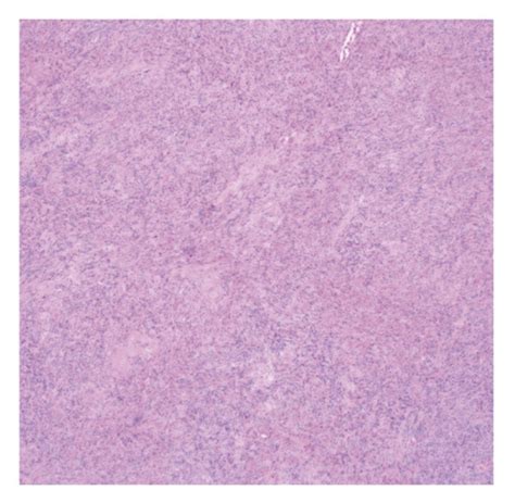 Microscopic Images Depict Ovarian Hyperthecosis With Stromal