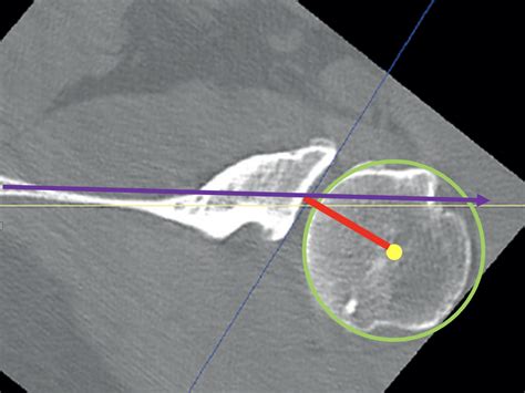 Uw Shoulder And Elbow Academy How Should The Retroverted Glenoid Be