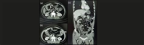 What Is Cect Whole Abdomen Procedure Benefits And More Ganesh Diagnostic