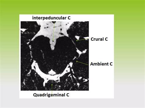 Basal Cisterns Finalppt