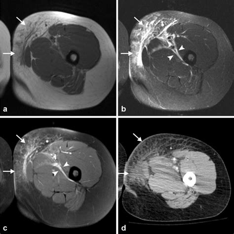 Miositis Qué Es Principales Tipos Causas Y Tratamiento