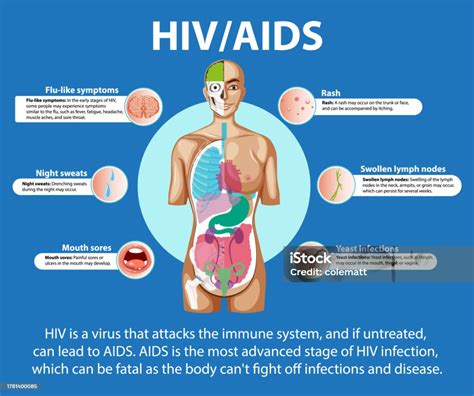 Impact Of Hiv Aids Virus On Human Immune System Stock Illustration
