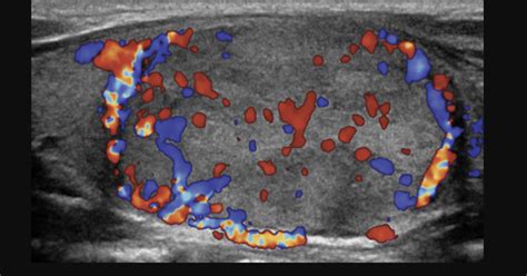 Photo Gallery What Do Thyroid Nodules Look Like On Imaging