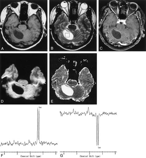 Brain Abscess And Necrotic Brain Tumor Discrimination With Proton Mr