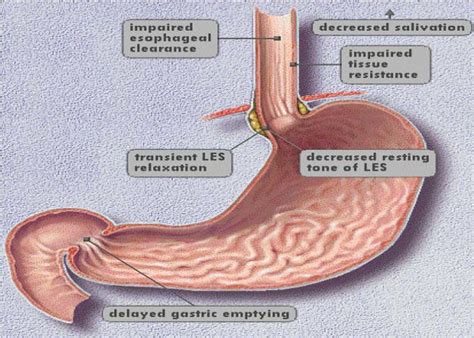 When Does The Ger Become Gerd Bullet Aberrance In Normal Physiology