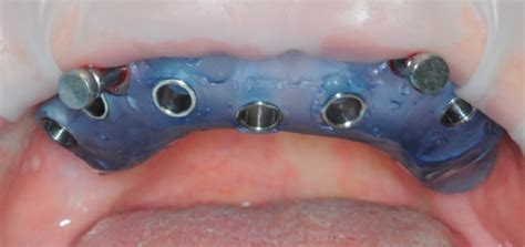 Surgical Guide In Place Download Scientific Diagram