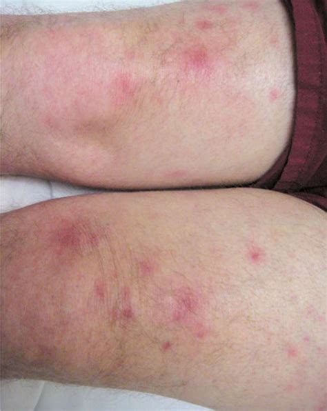 Epigastric Pain Vomiting And Elevated Lipase Level Manual Of Medicine